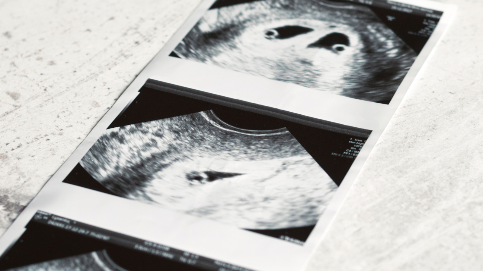 The Rare Phenomenon That Allows Twins To Have Different Fathers