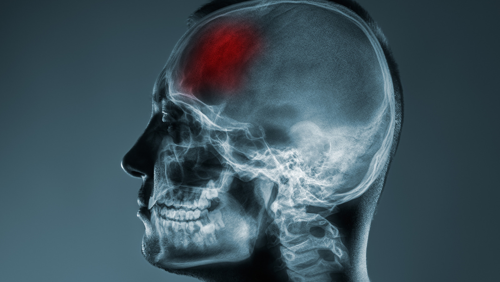 The Tragic Truth About Football Player Brains